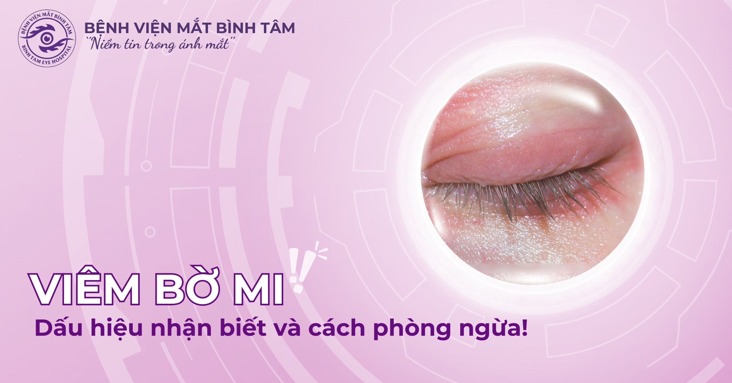 Viêm bờ mi mắt: Nguyên nhân, triệu chứng, cách điều trị và phòng ngừa ...